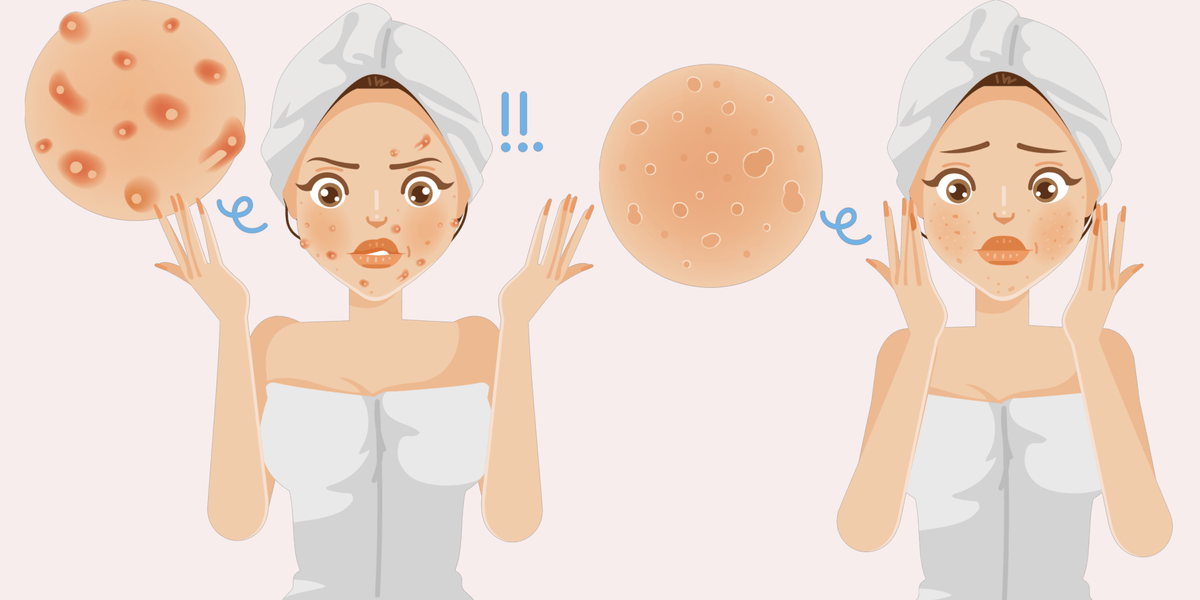 Acne Marks Vs Acne Scars Difference Between Acne Scars And Acne Marks