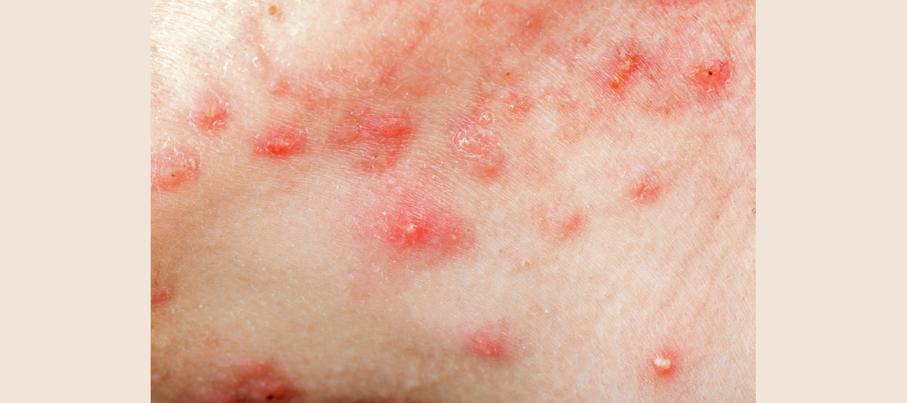 std acne on face