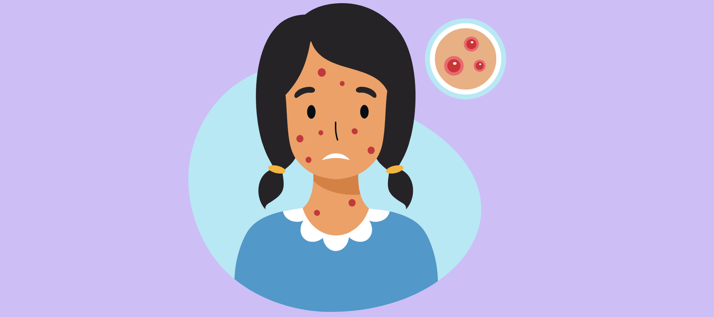 10 Reasons of Pimples on Face and How to Treat Them | The Pink Foundry
