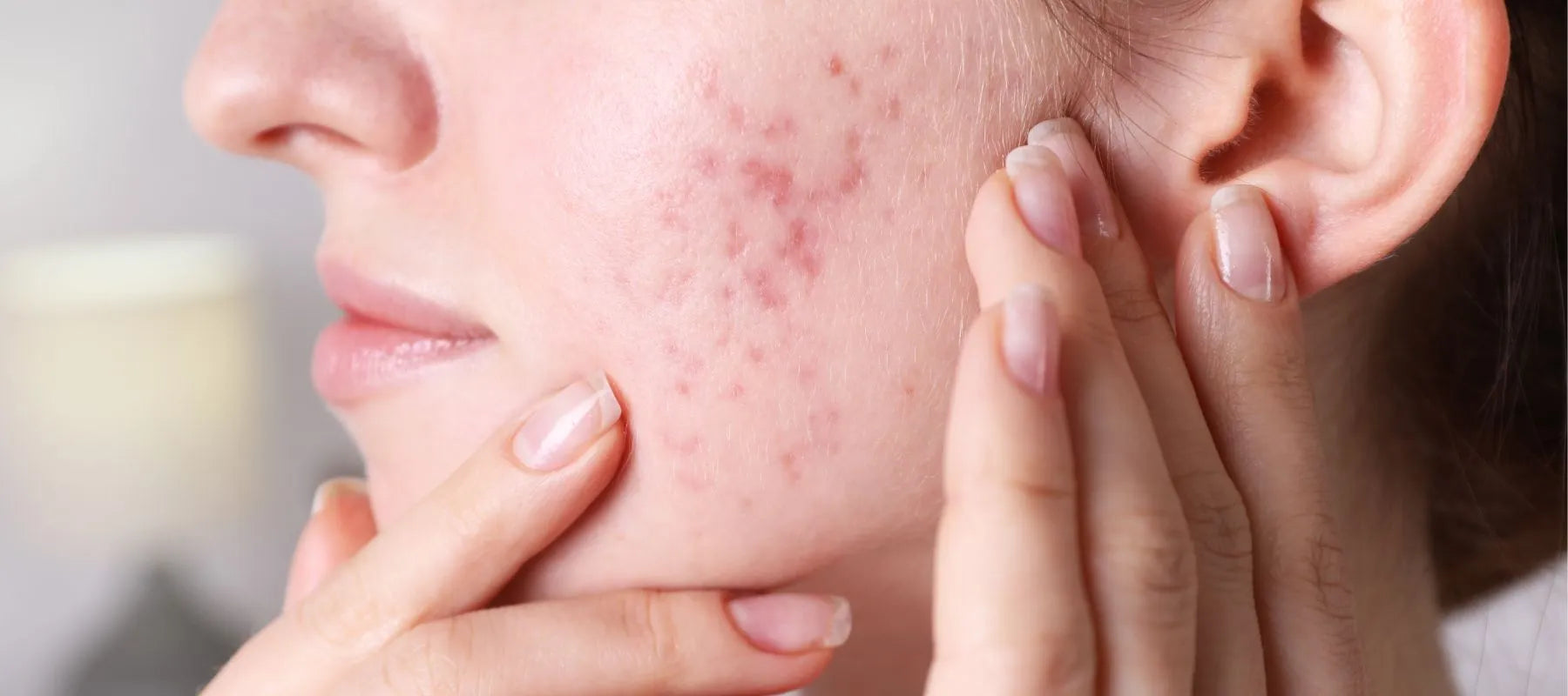 Redness Near Nose: Causes, Treatment & Skincare Tips | The Pink Foundry