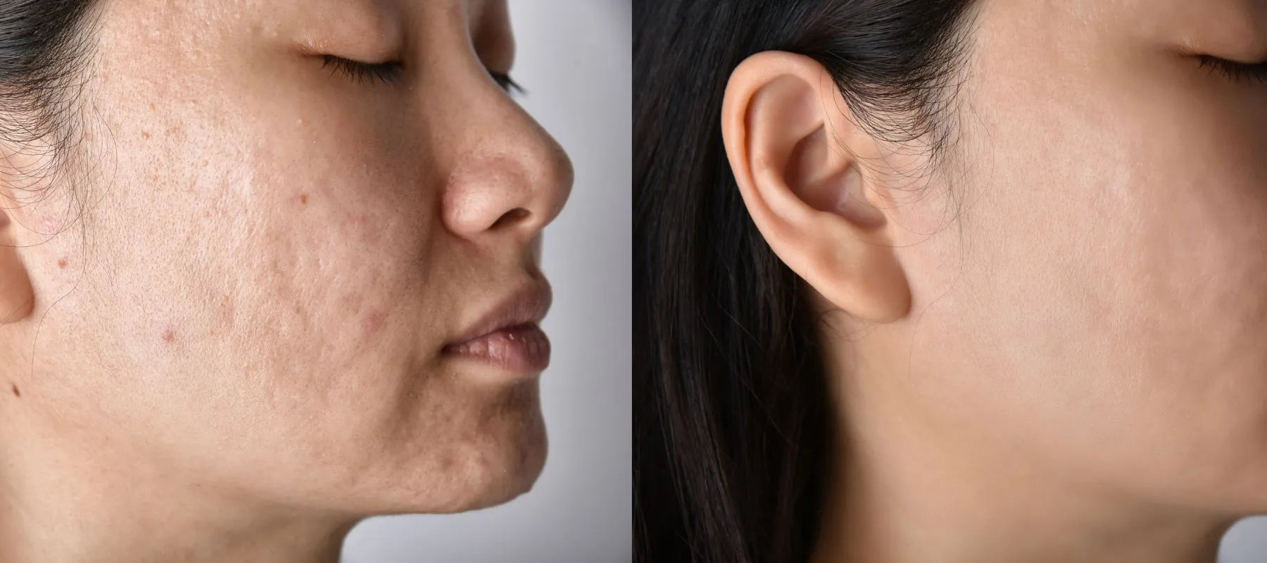 Know How Long Does It Take for Acne Scars to Fade | The Pink Foundry