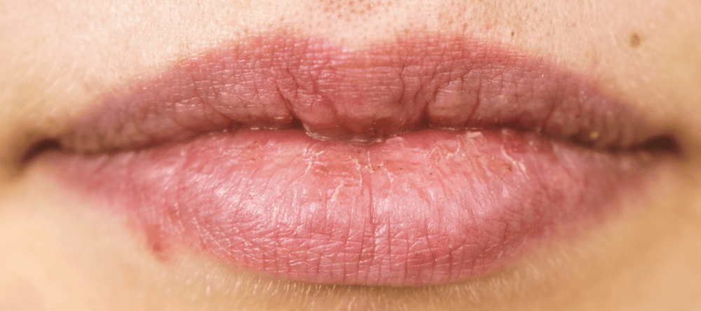 Pimple on Lip: How to Get Rid of Pimple on Lip | The Pink Foundry