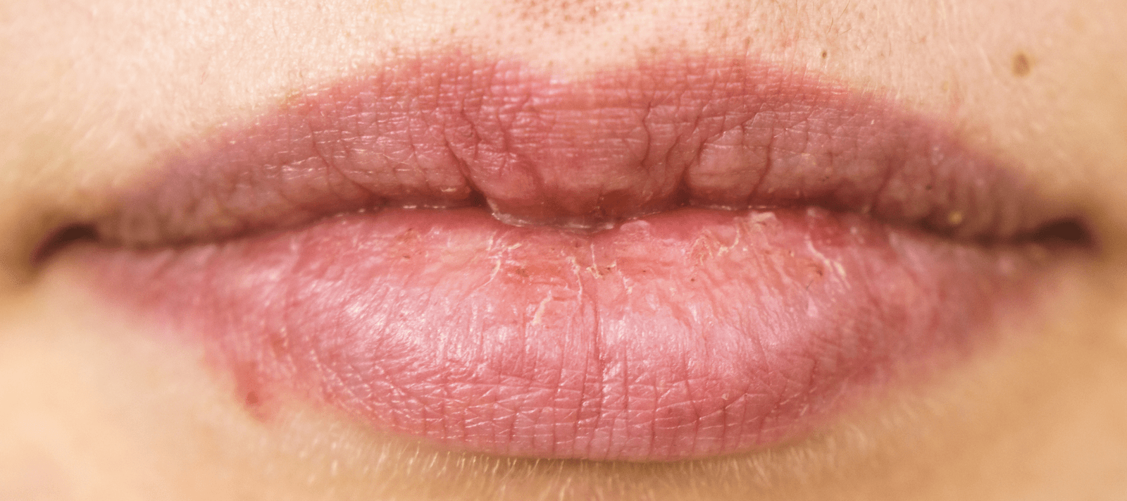 Pimple on Lip: How to Get Rid of Pimple on Lip | The Pink Foundry
