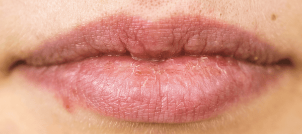 Pimple on Lip: How to Get Rid of Pimple on Lip | The Pink Foundry