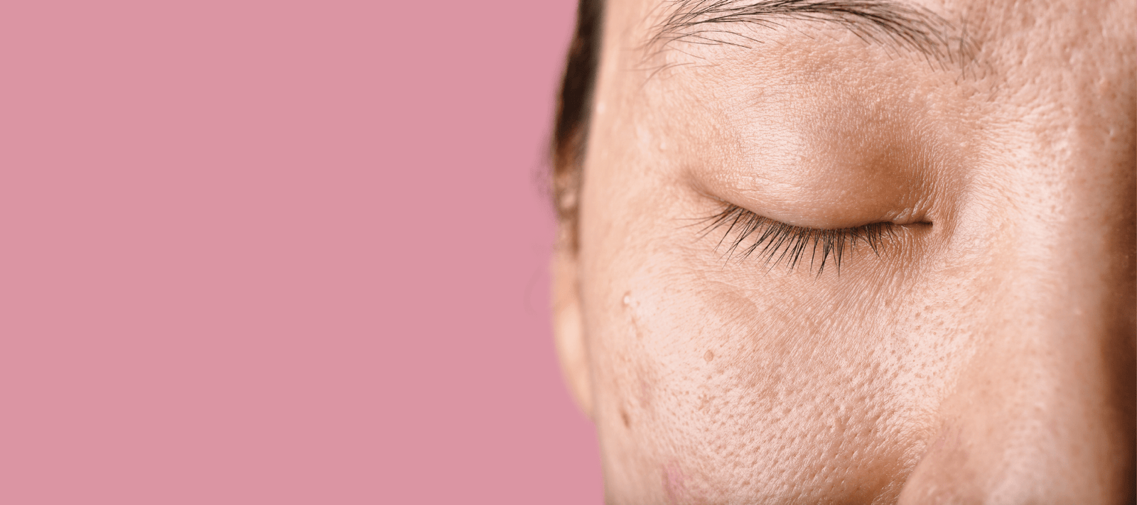 Age Spots on Face: Causes and Treatment | The Pink Foundry