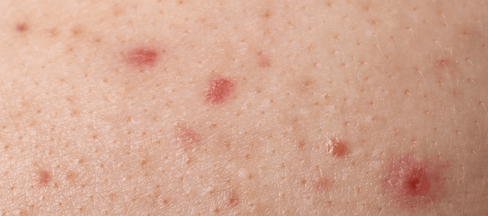 Comedones 101: Comedones Meaning and Causes - The Pink Foundry