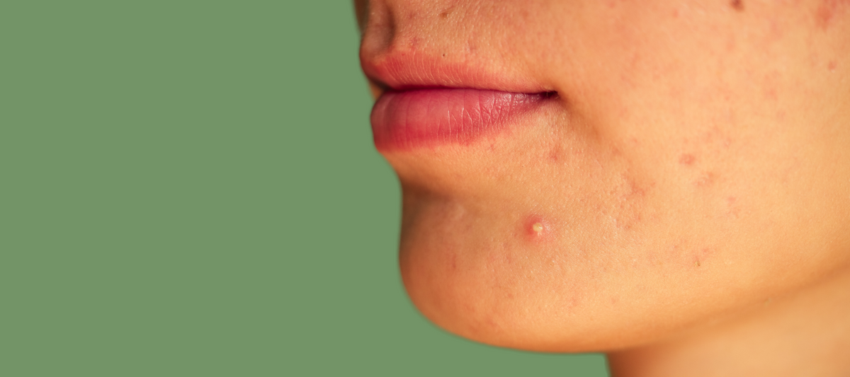 Cystic Acne on Face: Causes, Treatment, and Tips | The Pink Foundry