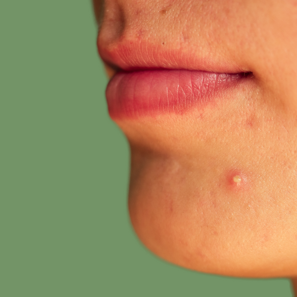 Cystic Pimple On Nose