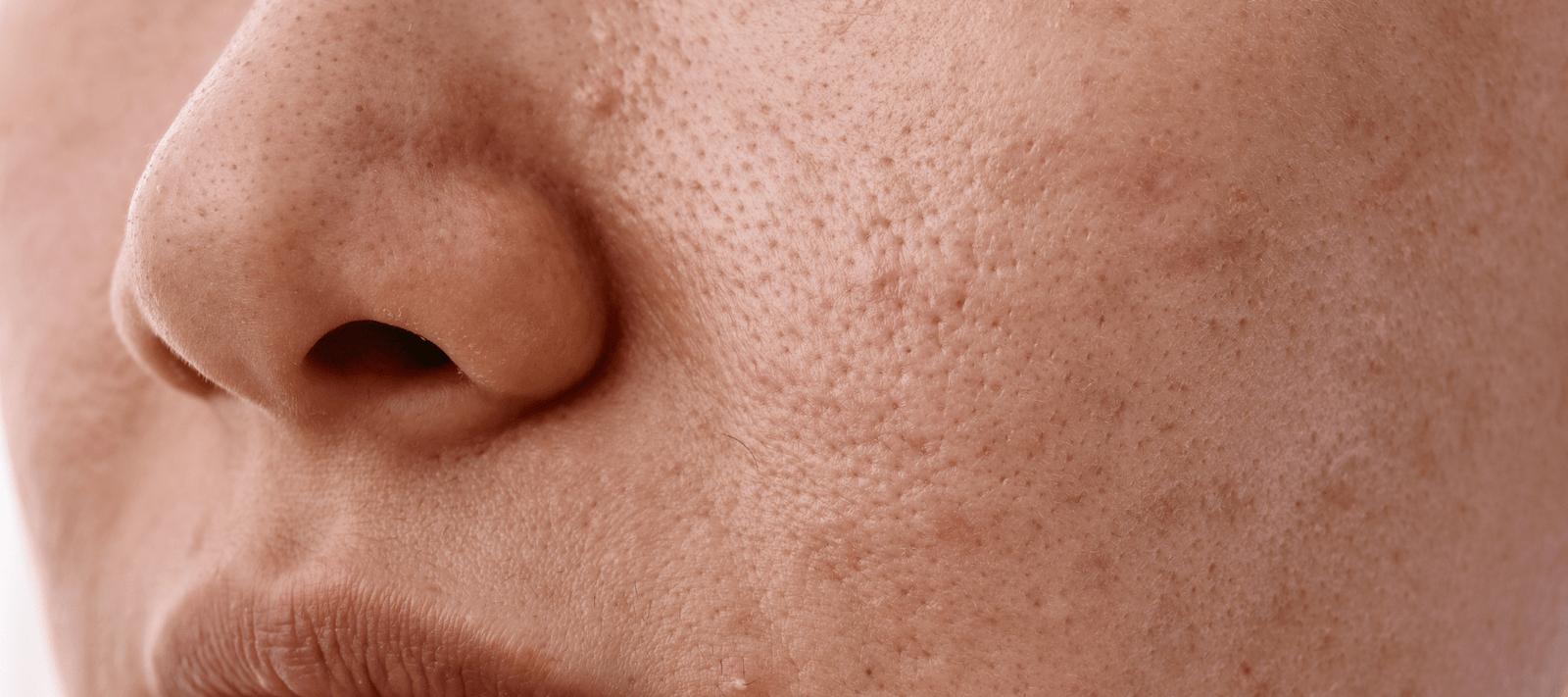 Pitted Scars: Causes, Types, and Effective Treatments | The Pink Foundry