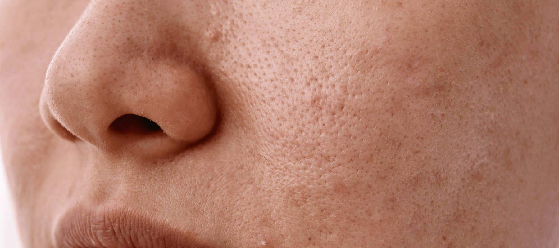 Pitted Acne Scars Multiple Discrete Pitted Scars Over The Face