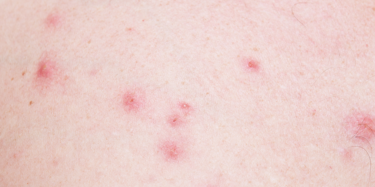 Difference Between Acne and Pimples & How To Reduce It - The Pink Foundry