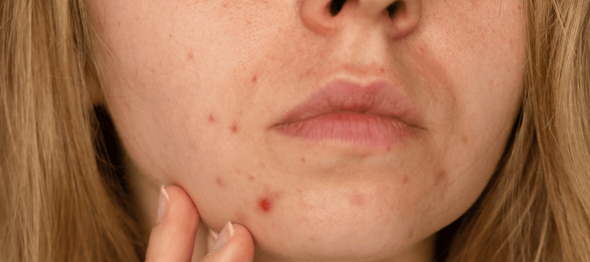 What to do After Accidentally Popping a Pimple? - The Pink Foundry