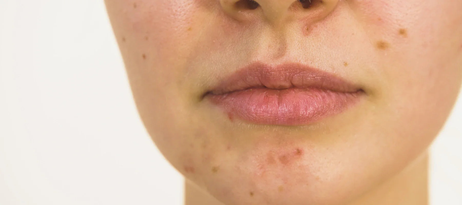 Dry Skin Pimples - Causes, Symptoms, And Effective Treatment Options ...