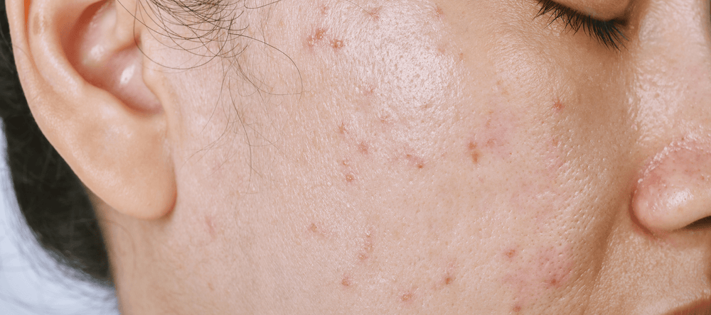 Textured Skin: Everything You Need To Know | The Pink Foundry
