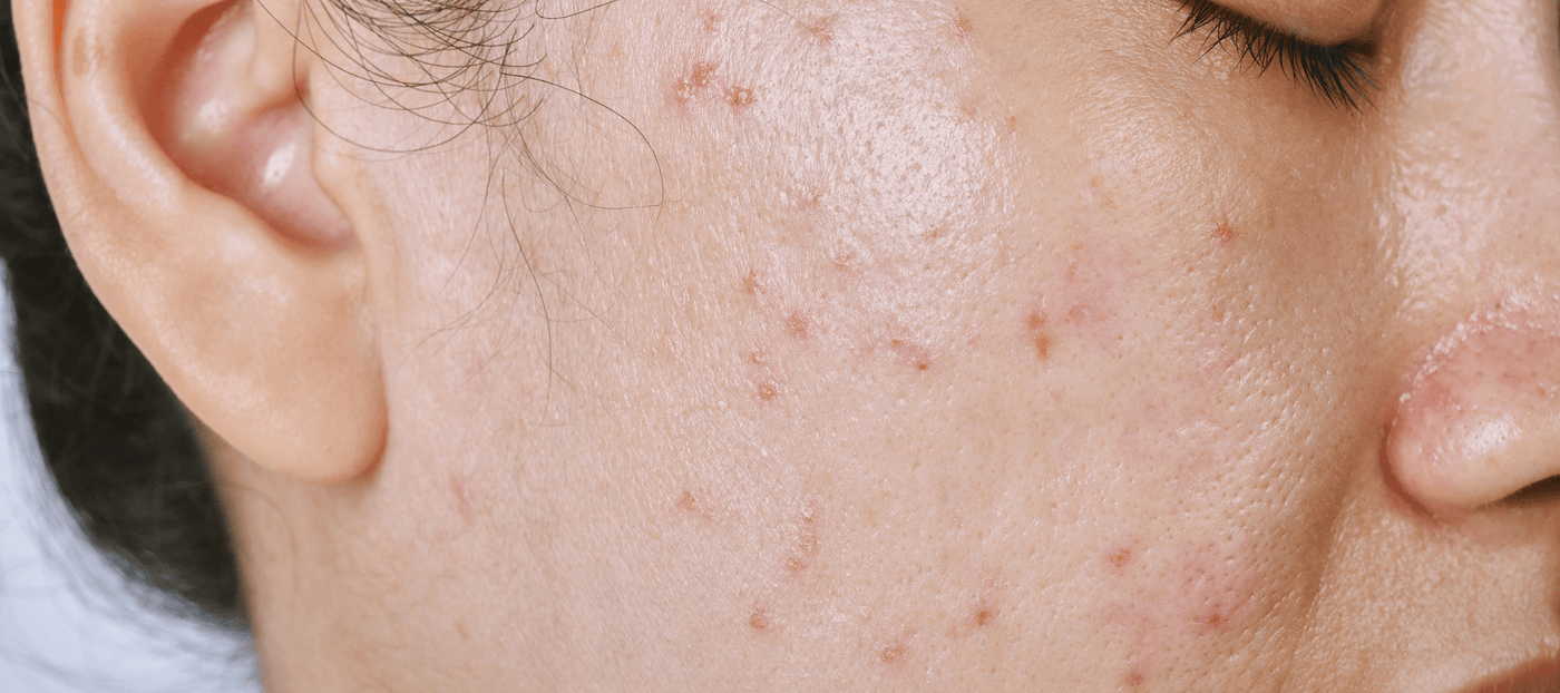 Sebum On Face: Effects on Skin, Treatment & Solution | The Pink Foundry