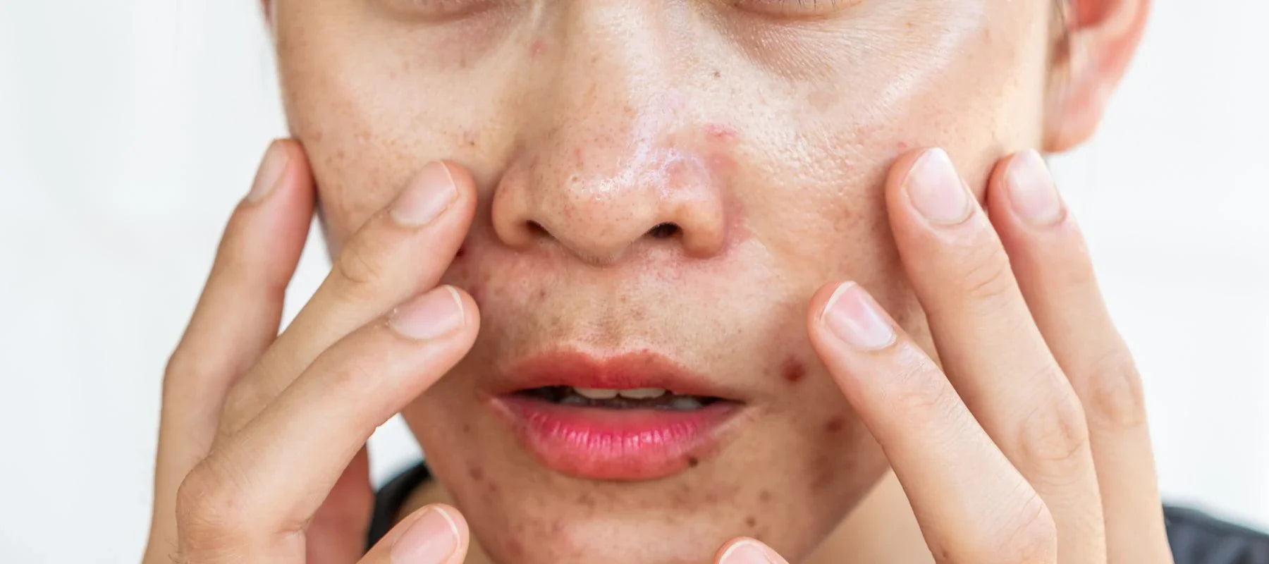 T-Zone on the face: Causes and treatment for oily face T-Zone | The ...