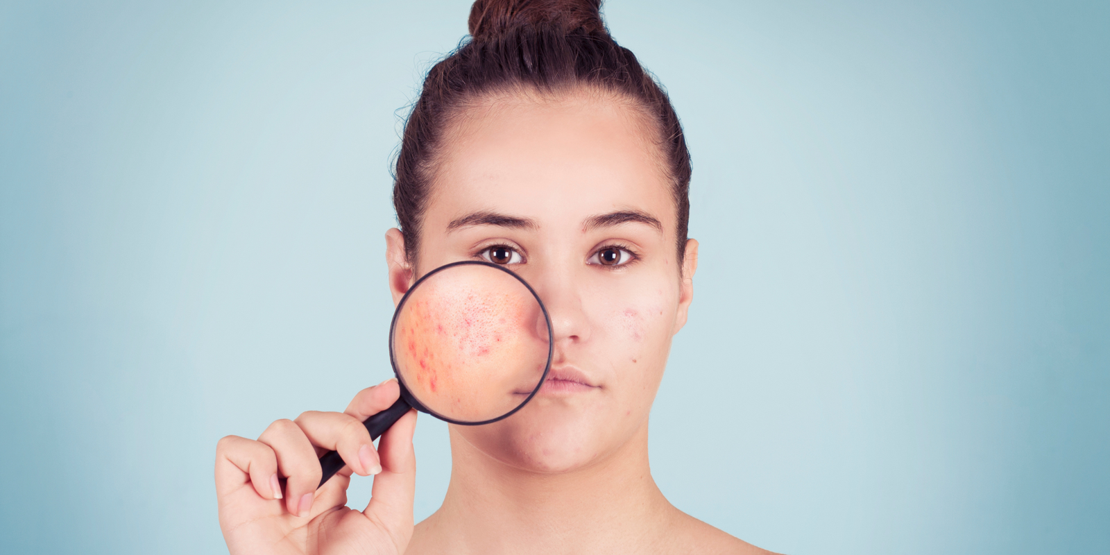 Retinol for Acne: Complete Guide to Clearing Your Skin | The Pink Foundry
