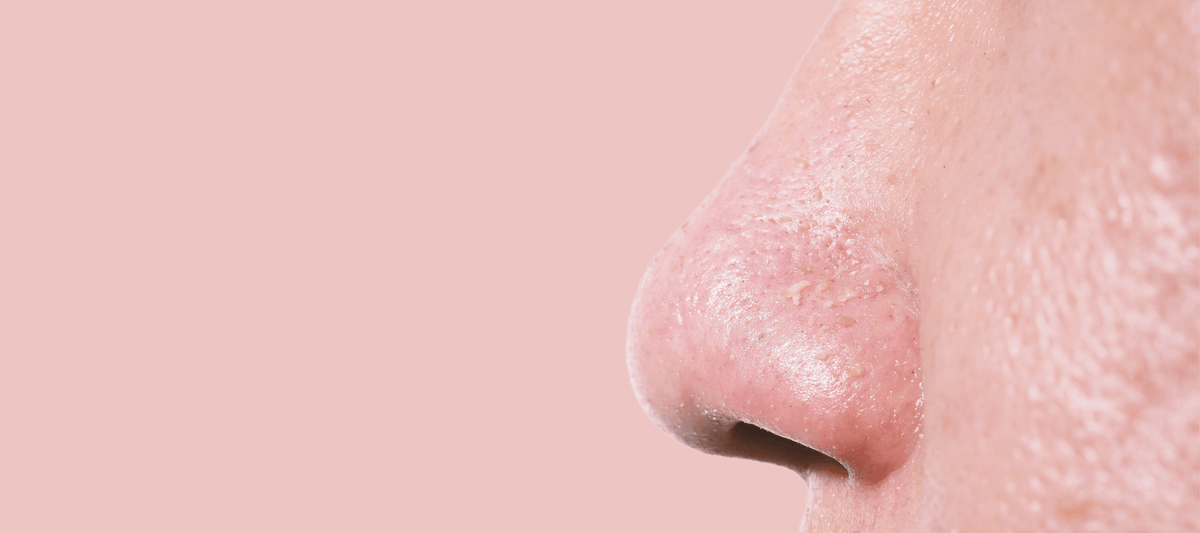 Closed Comedones Treatment for Clear and Flawless Skin | The Pink Foundry