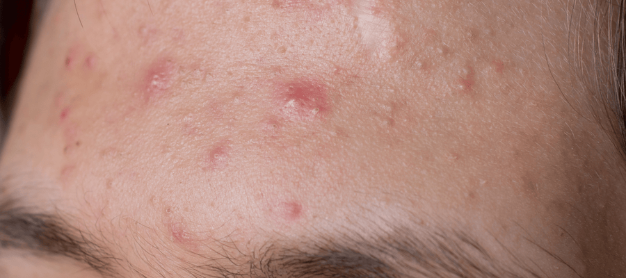 Forehead Acne Causes and How to Get Rid of Forehead Acne | The Pink Foundry