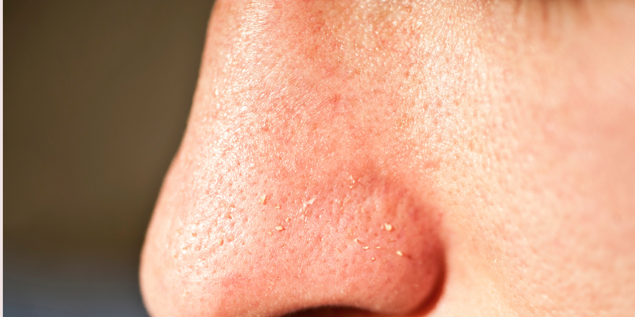 How Are Whiteheads Formed And How To Prevent Them- The Pink Foundry
