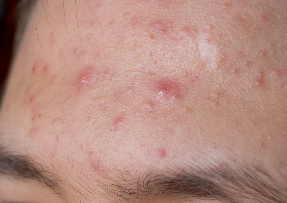 How to Get Rid of Winter Acne: Tips for How to Get Rid of Pimple in ...