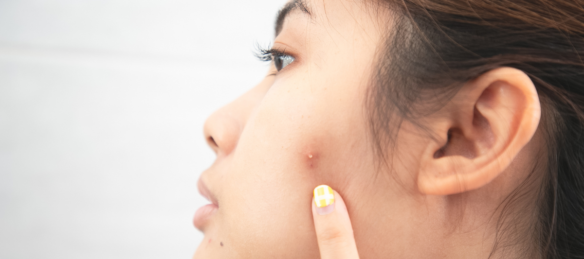 How to prevent pimples on the face | The Pink Foundry
