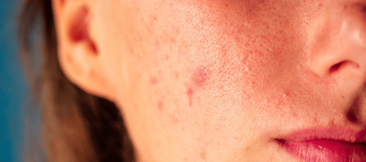 Acne on Cheeks: How to Get Rid of Cheek Acne | The Pink Foundry