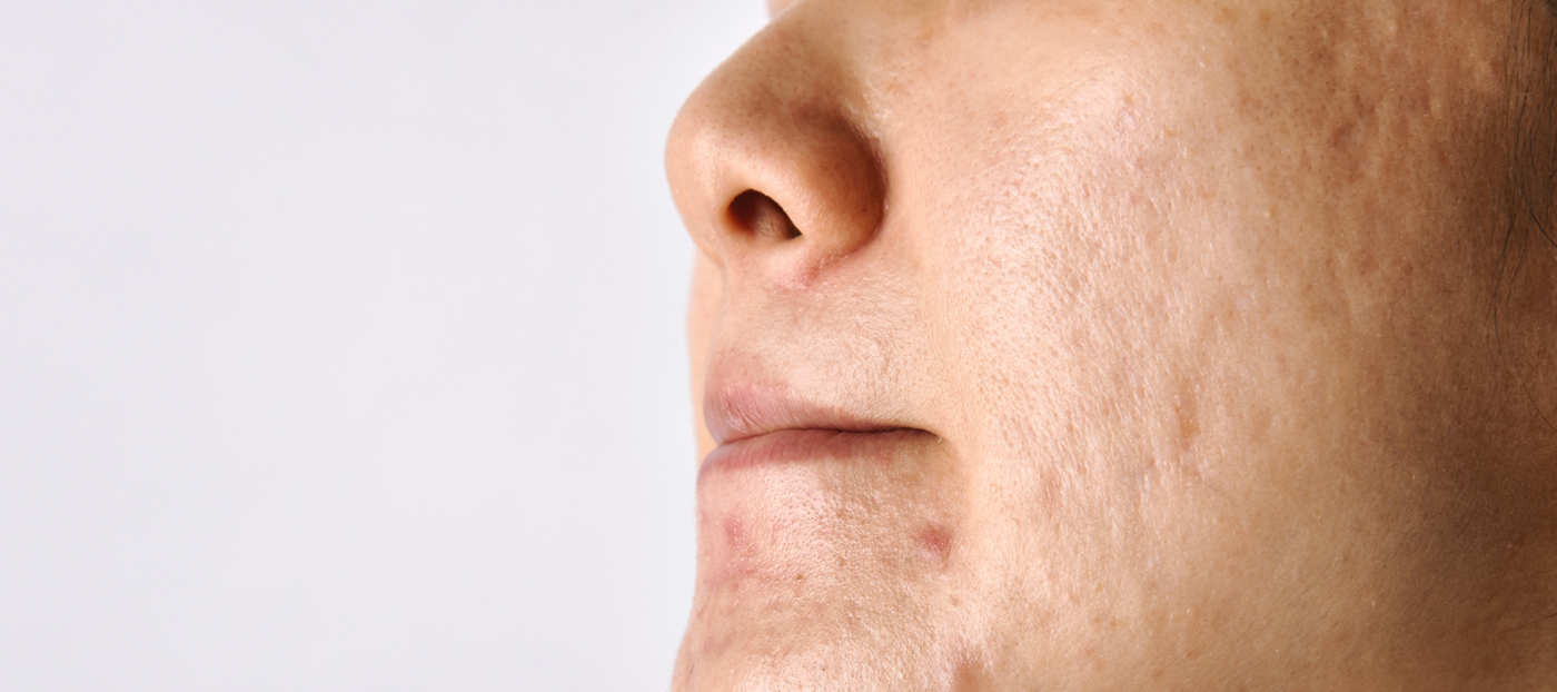 How to Get Rid of Pimples, Marks, & Spots Effectively | The Pink Foundry