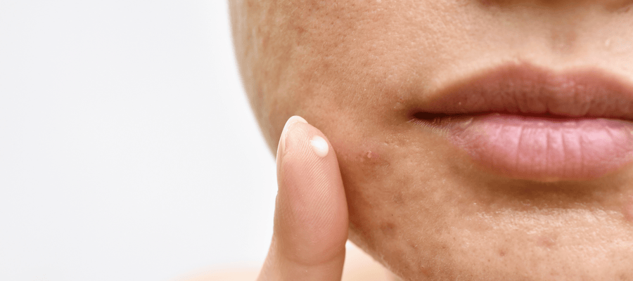 How to Remove Pimple Marks: Tips and Treatment | The Pink Foundry