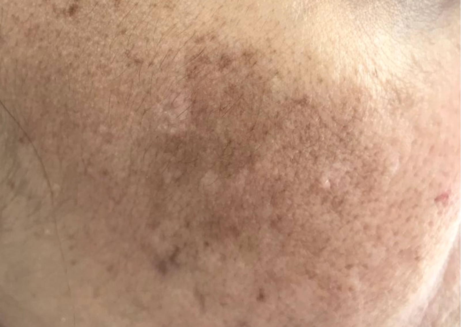 Hyperpigmentation: Causes and Treatment of Hyperpigmentation - The Pink ...