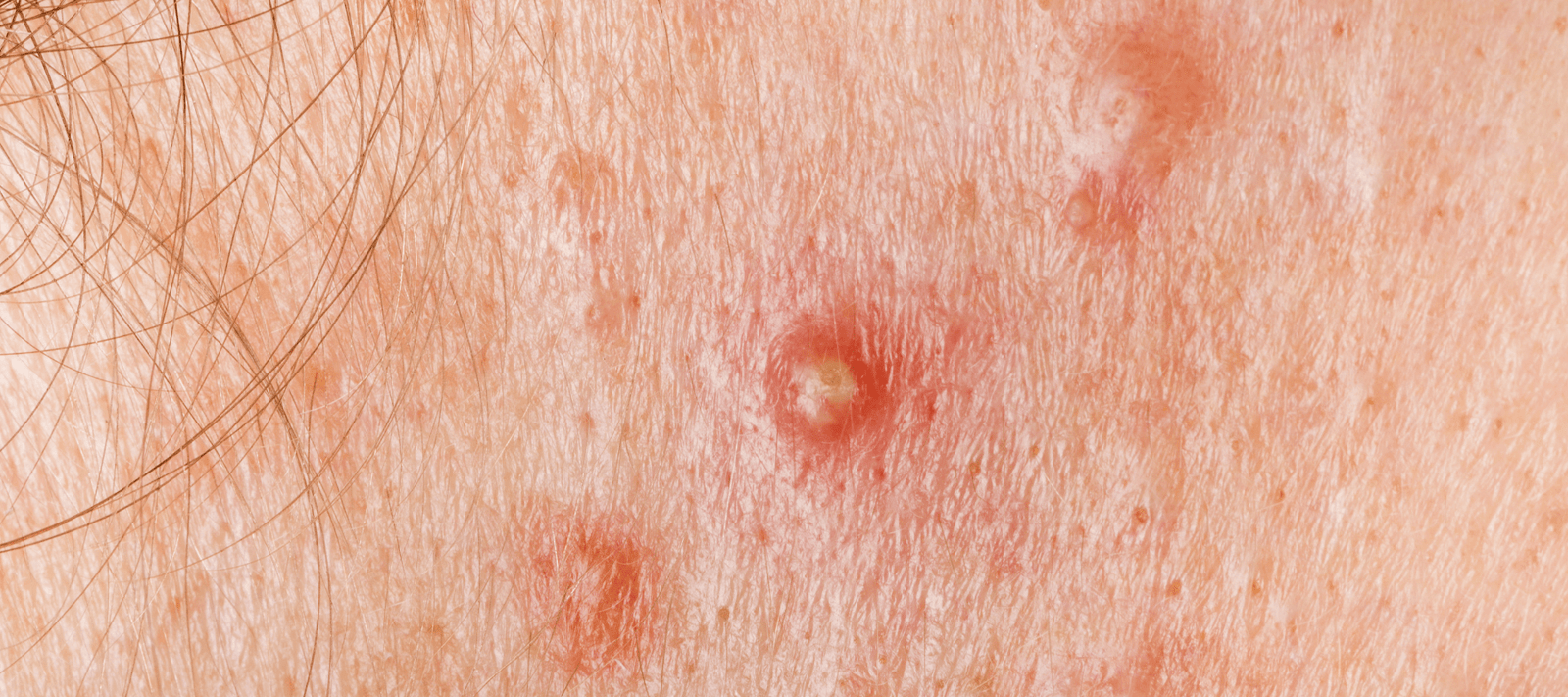 Nodular Acne: Causes, Symptoms, and Effective Treatments | The Pink Foundry