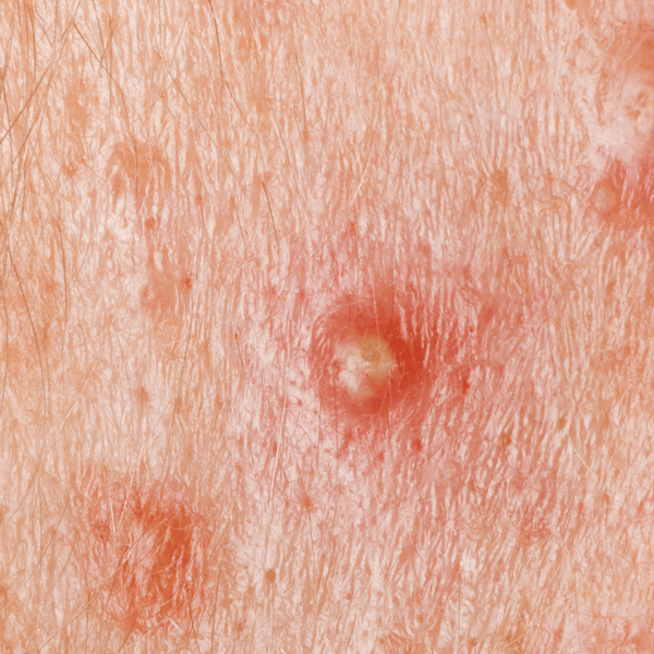 Nodular Acne How To Get Rid Of Cystic Acne According To A