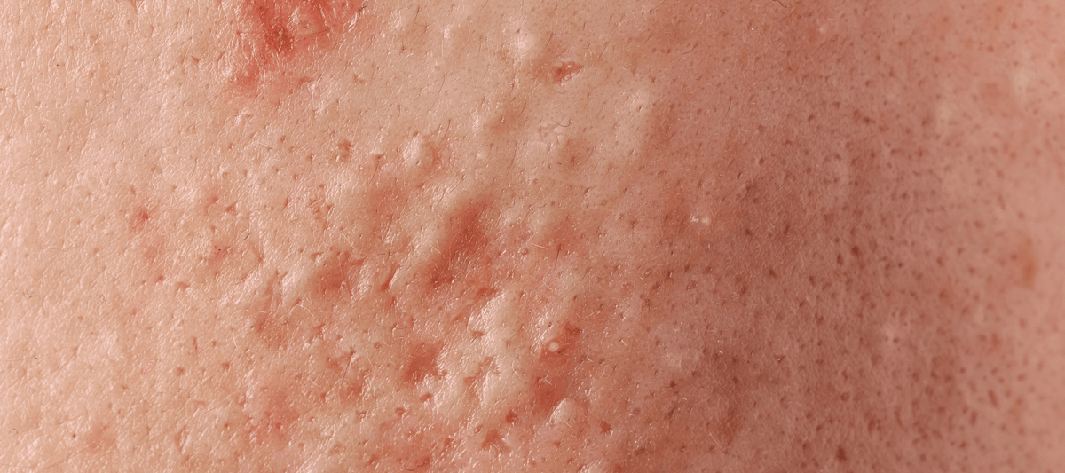 Your Ultimate Guide to Comedones on Face: Causes and Treatments - The ...