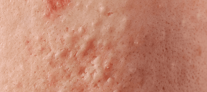 Your Ultimate Guide to Comedones on Face: Causes and Treatments - The ...