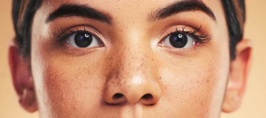 Melasma Treatment: How To Treat Melasma On Face | The Pink Foundry