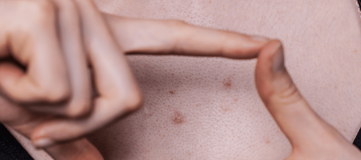 Neck Pimples: Understanding Their Meaning and Causes | The Pink Foundry