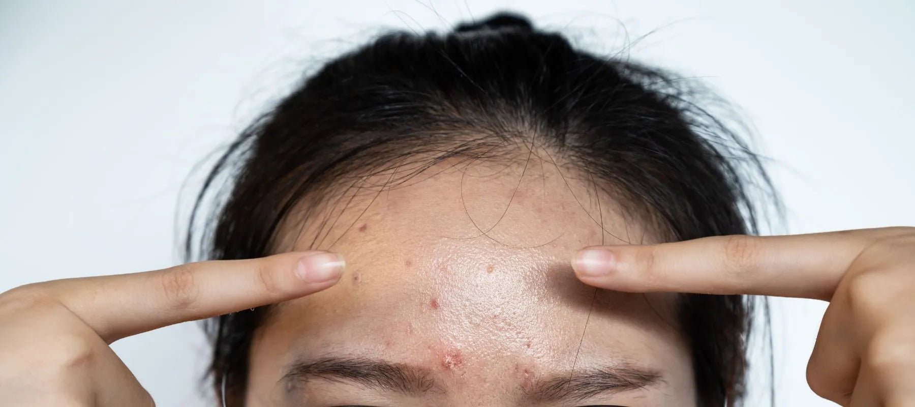 Phytophotodermatitis: Symptoms, Causes, and Effective Treatment | The ...