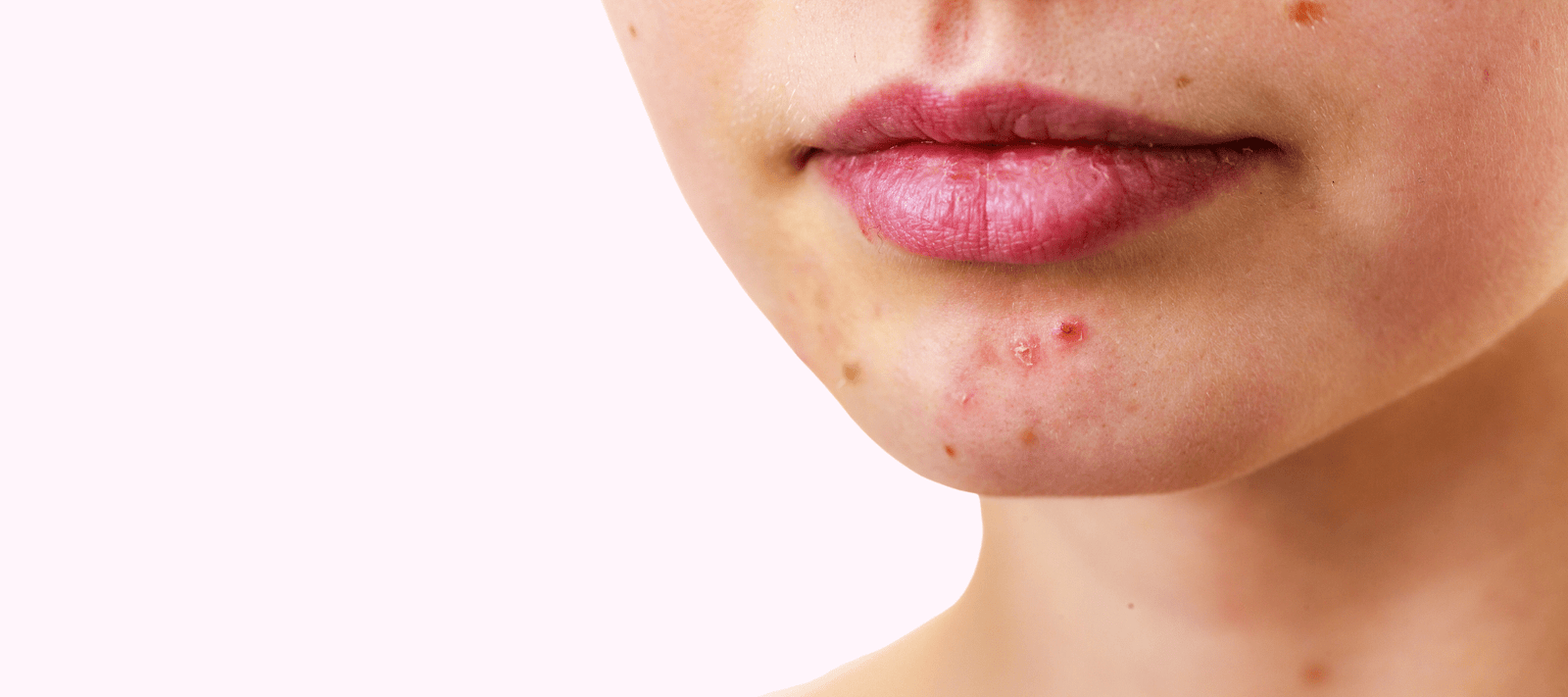 Pustule Acne: What Causes Those Pesky Acne on Your Face | The Pink Foundry