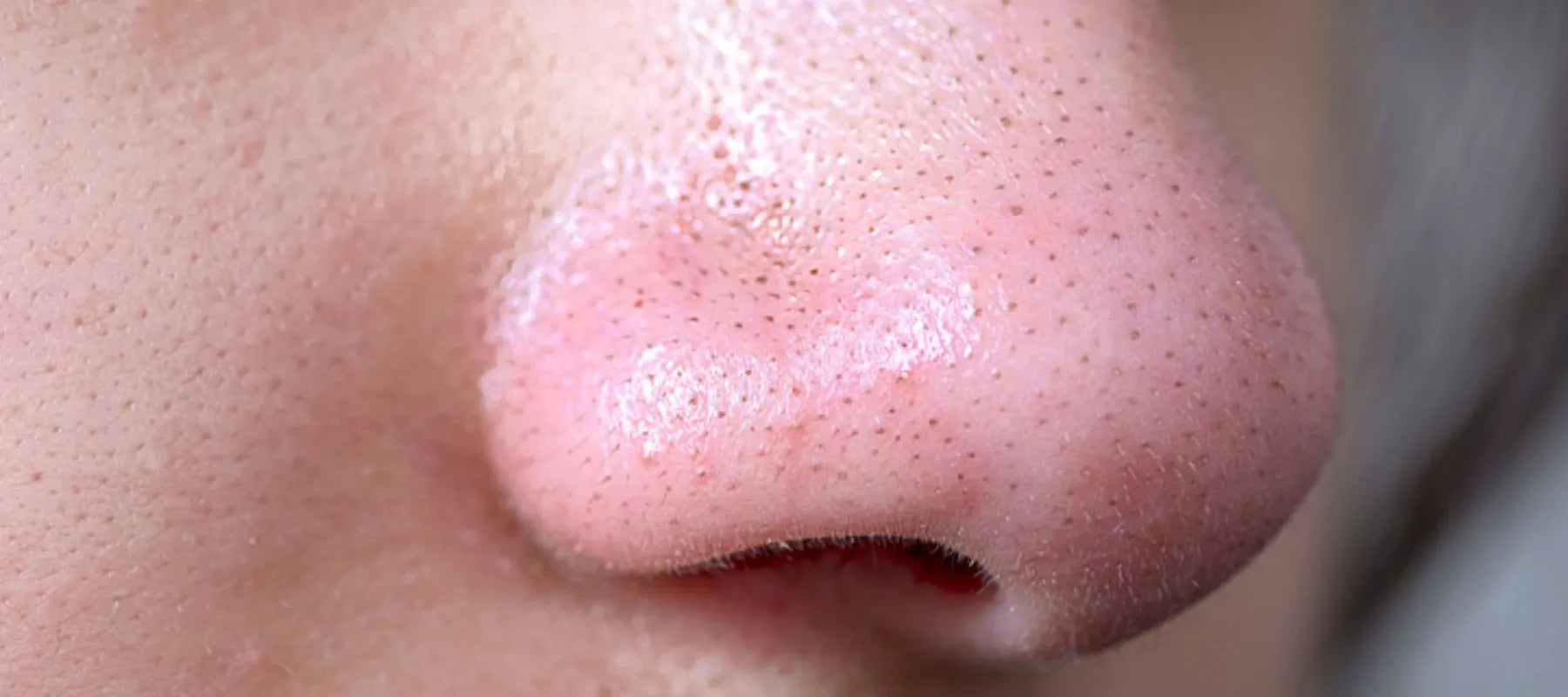 Sebum Filaments: How to Minimise Sebaceous Filament on Nose | The Pink ...