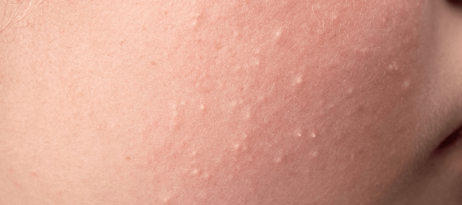Understanding Small Bumps on Face: Not Acne, but What are They? - The ...
