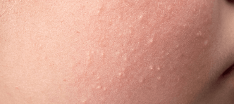 Understanding Small Bumps on Face: Not Acne, but What are They? - The ...