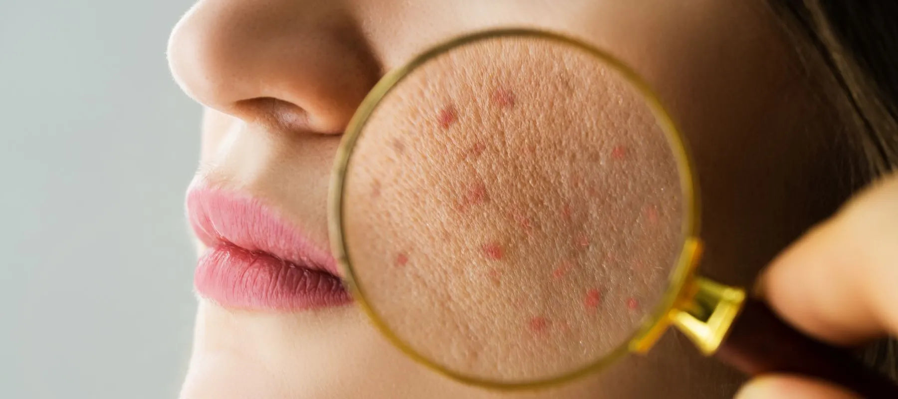 Stages of Acne: Understanding the Healing Process and Treatment | The ...