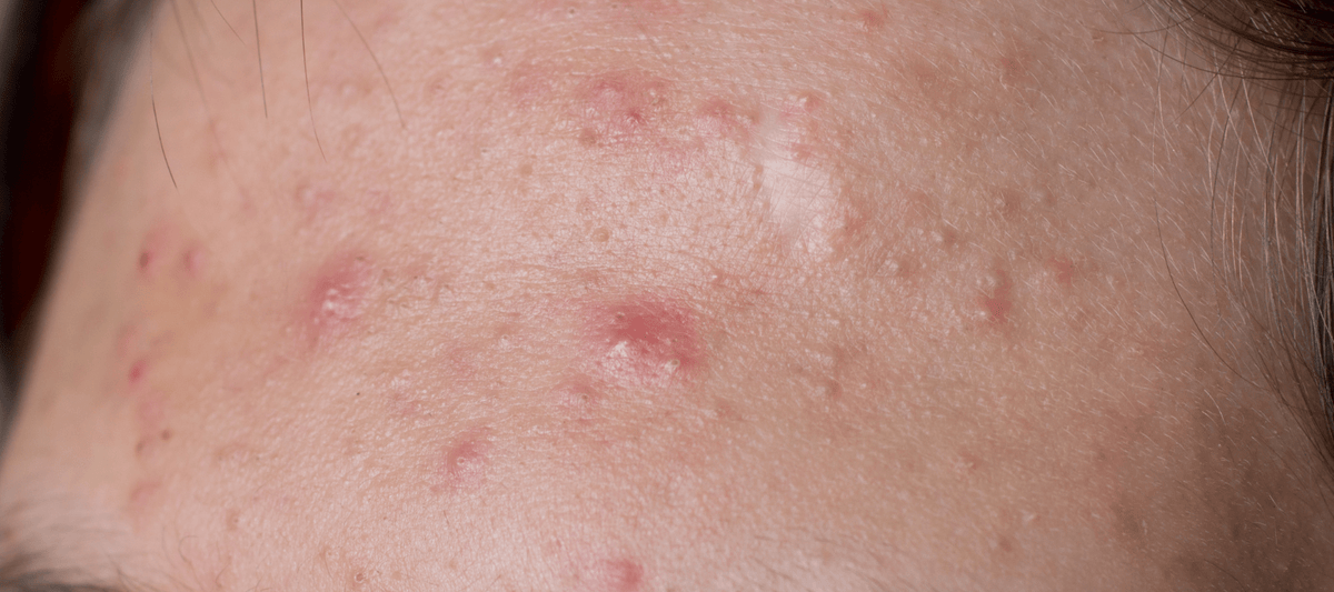 Using Benzoyl Peroxide for Pimples: Your Ultimate How-to Guide | The ...