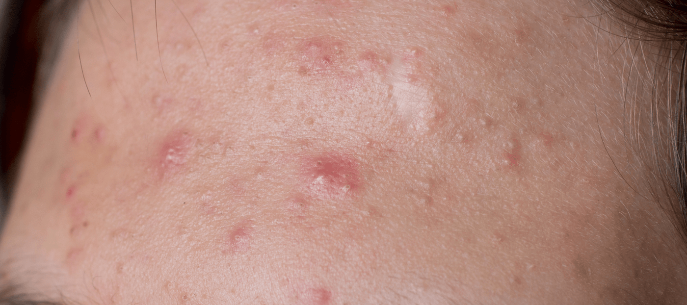 Using Benzoyl Peroxide for Pimples: Your Ultimate How-to Guide | The ...