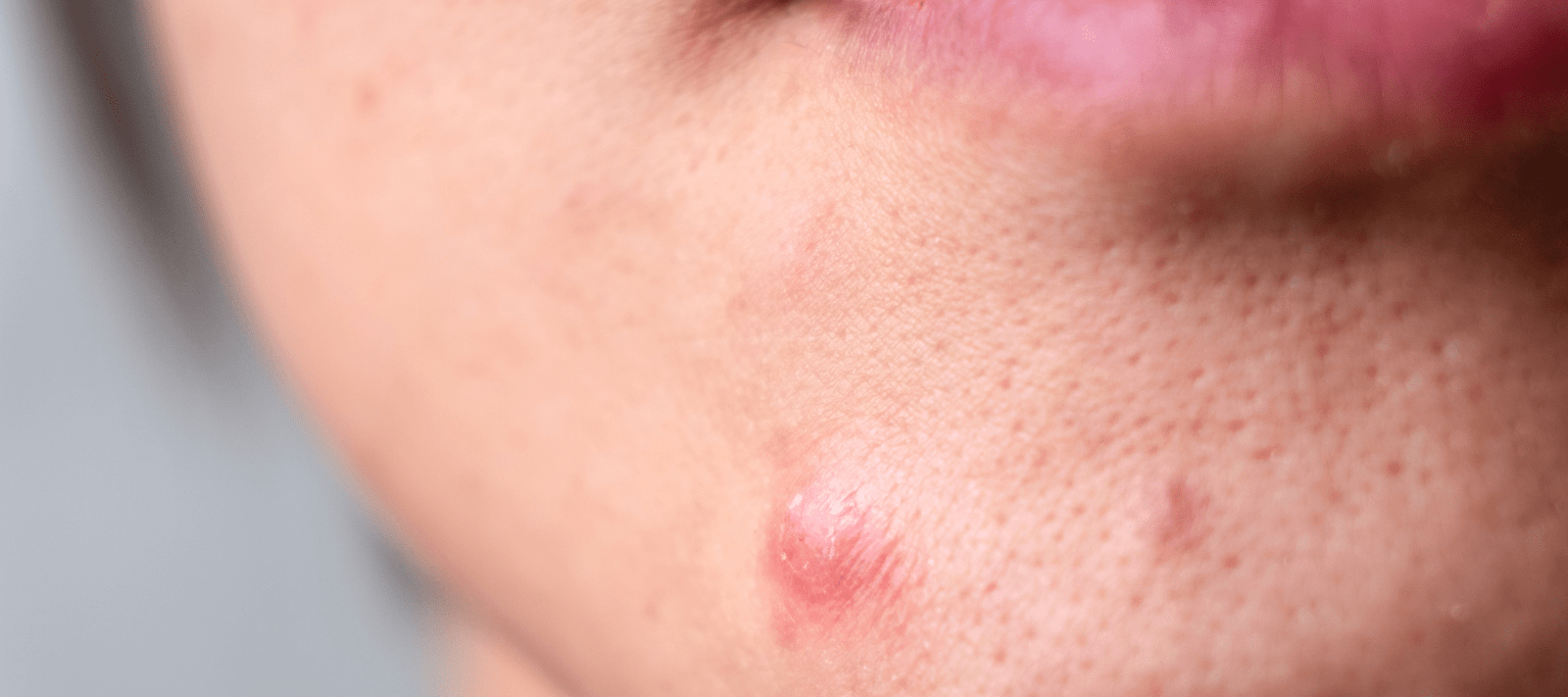 Pimples on Chin - Indicates, Reasons, How to Get Rid of Pimples on Chin ...