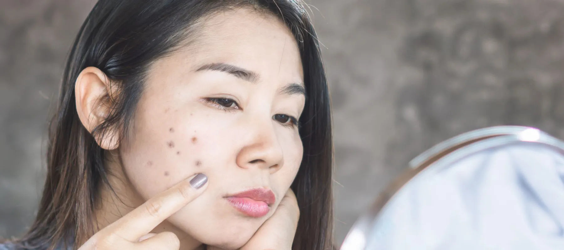 Home Remedies for Dark Spots and Marks on Face from Pimples | The Pink ...