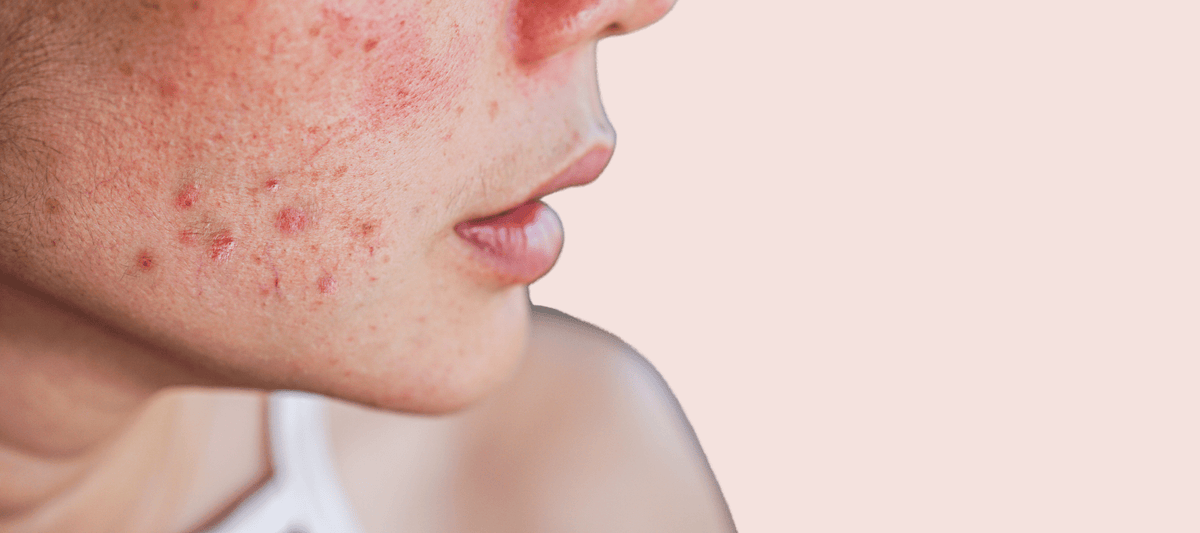 Understanding the Different Types of Acne on Your Face | The Pink Foundry