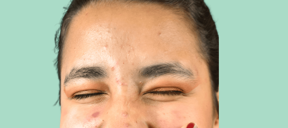 How To Get Rid of Bumps On The Face Quickly | The Pink Foundry