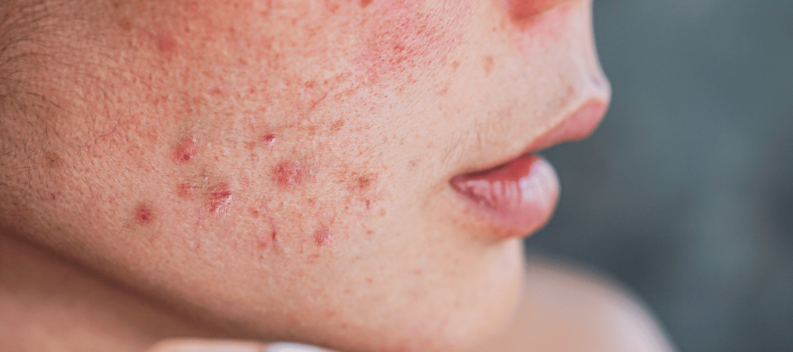 Guide to Mild, Moderate, and Severe Acne | The Pink Foundry