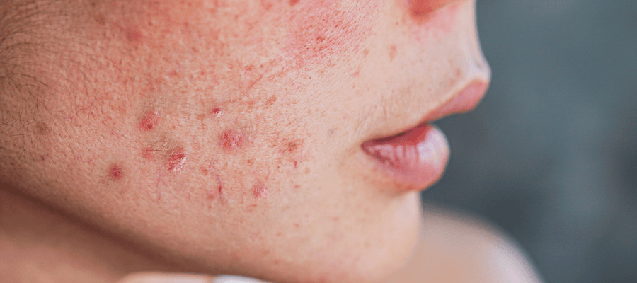 Guide to Mild, Moderate, and Severe Acne | The Pink Foundry